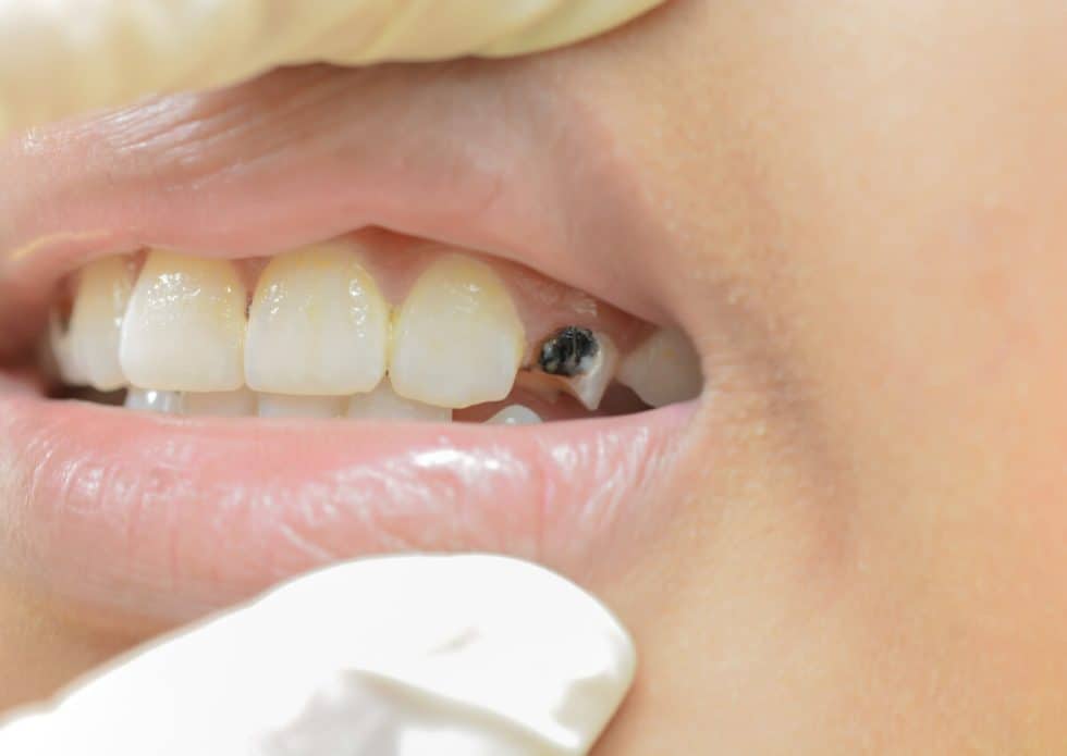 Cavities Prevention: How You Can Fight Cavities Away